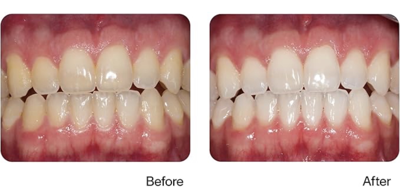 whitening | Chenin Orthodontics